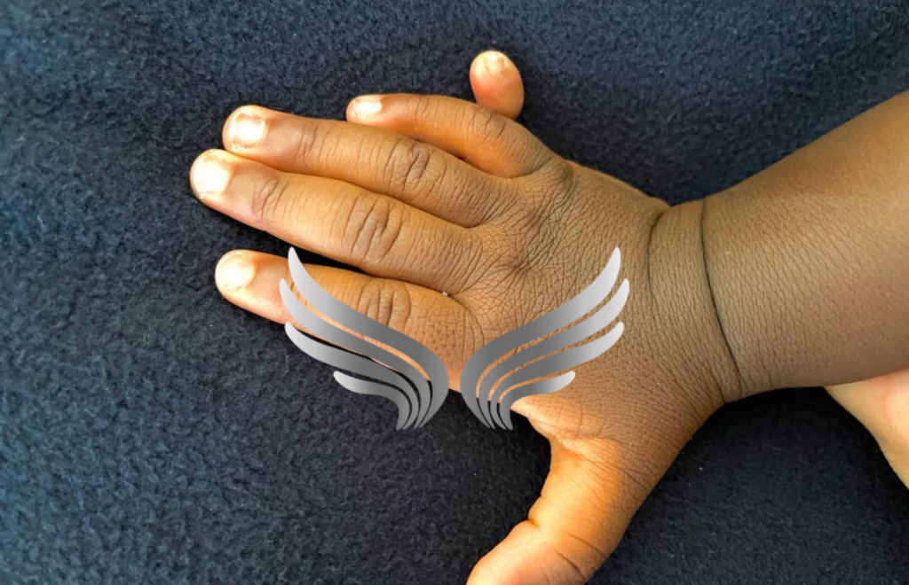 Polidactilia, en qué consiste - Dra. Carolina Correa